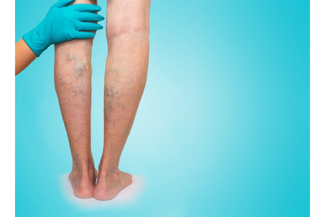 Insufficienza venosa | Cos'è, come curarla, cosa mangiare, prevenirla | Farmacie del sorriso